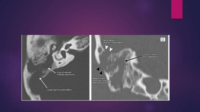 High Resolution Computer TomographyTEMPORAL BONE Pathology.pptx