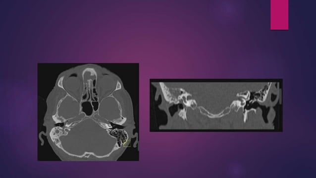 High Resolution Computer TomographyTEMPORAL BONE Pathology.pptx