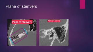 High Resolution Computer TomographyTEMPORAL BONE Pathology.pptx