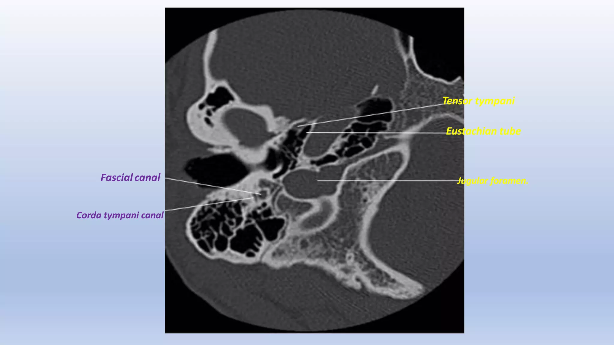 Hrct temporal bone pk1 ppt | PPTX