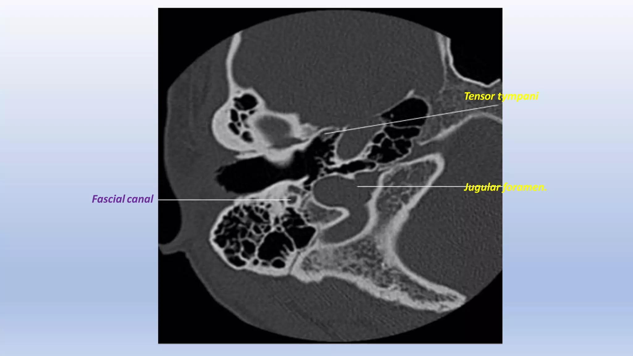 Hrct temporal bone pk1 ppt | PPTX