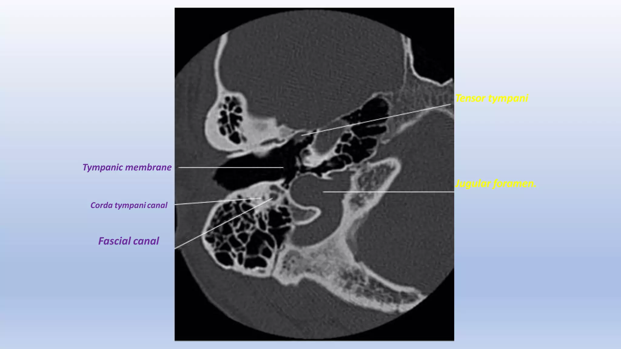 Hrct temporal bone pk1 ppt | PPTX