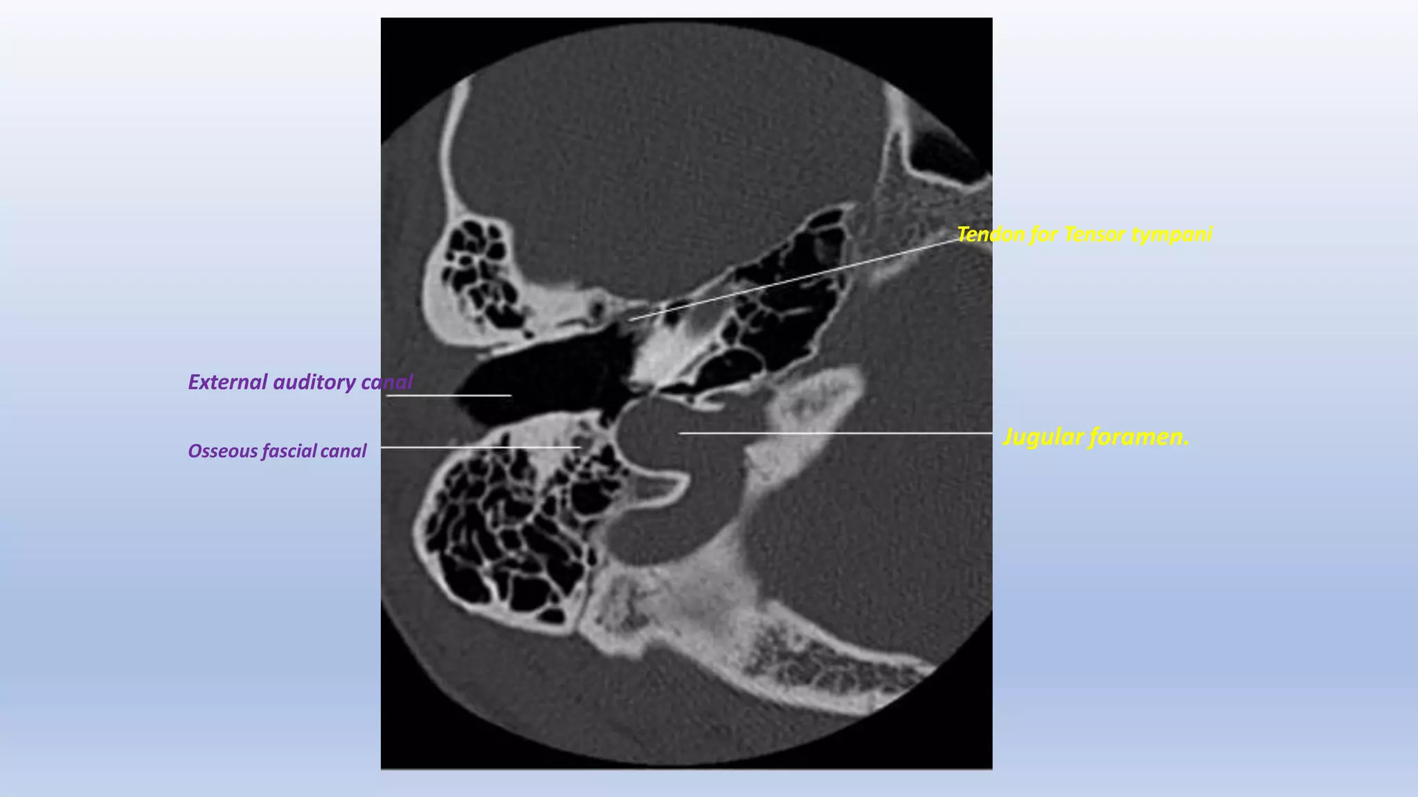Hrct temporal bone pk1 ppt | PPTX