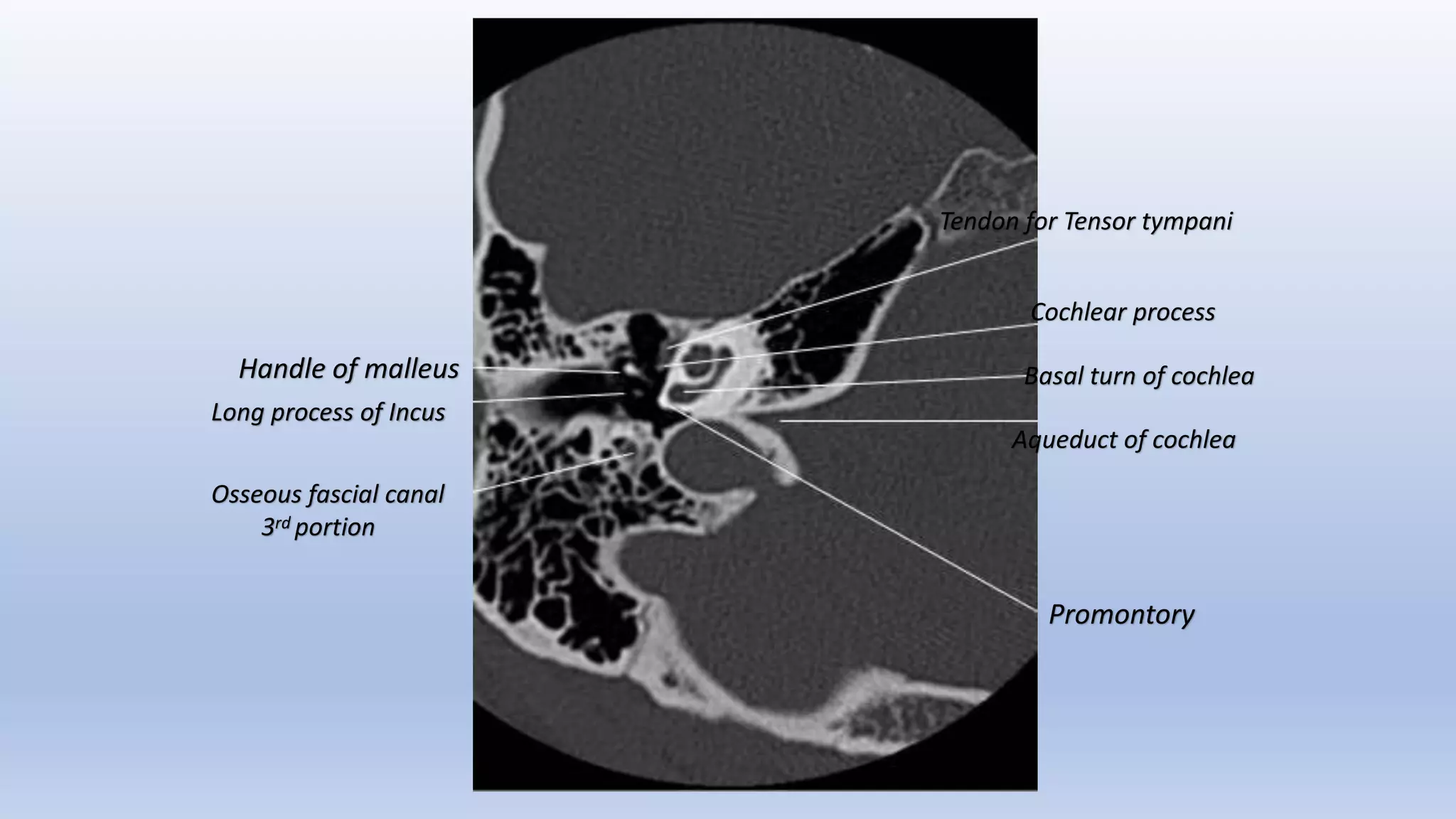 Hrct temporal bone pk1 ppt | PPTX