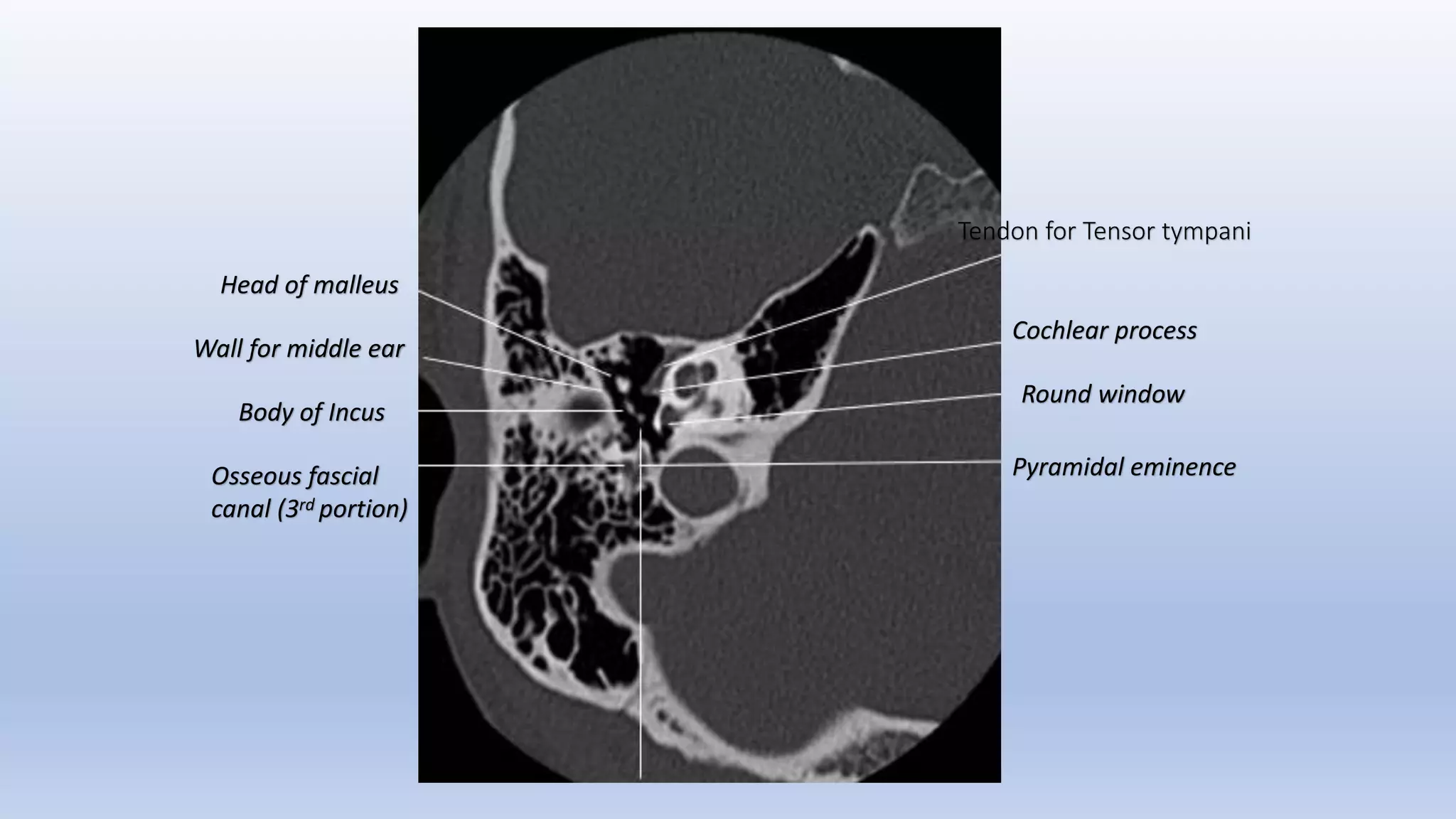 Hrct temporal bone pk1 ppt | PPTX