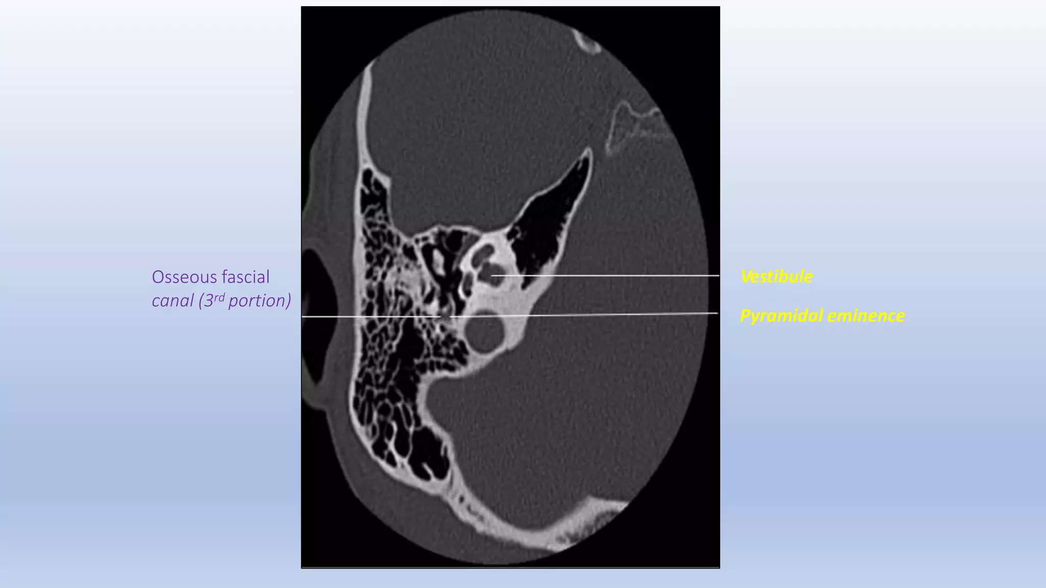 Hrct temporal bone pk1 ppt | PPTX