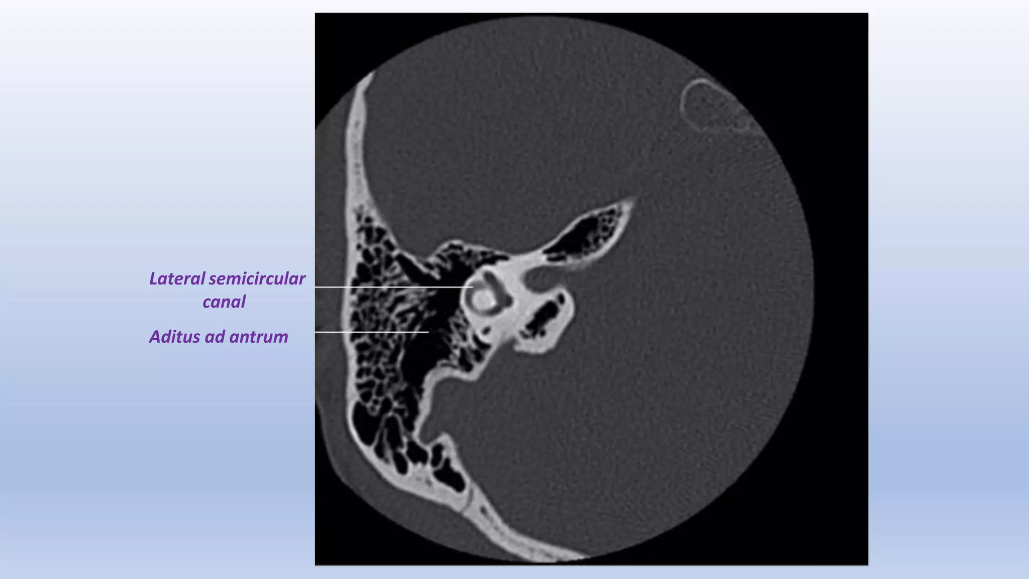 Hrct temporal bone pk1 ppt | PPTX