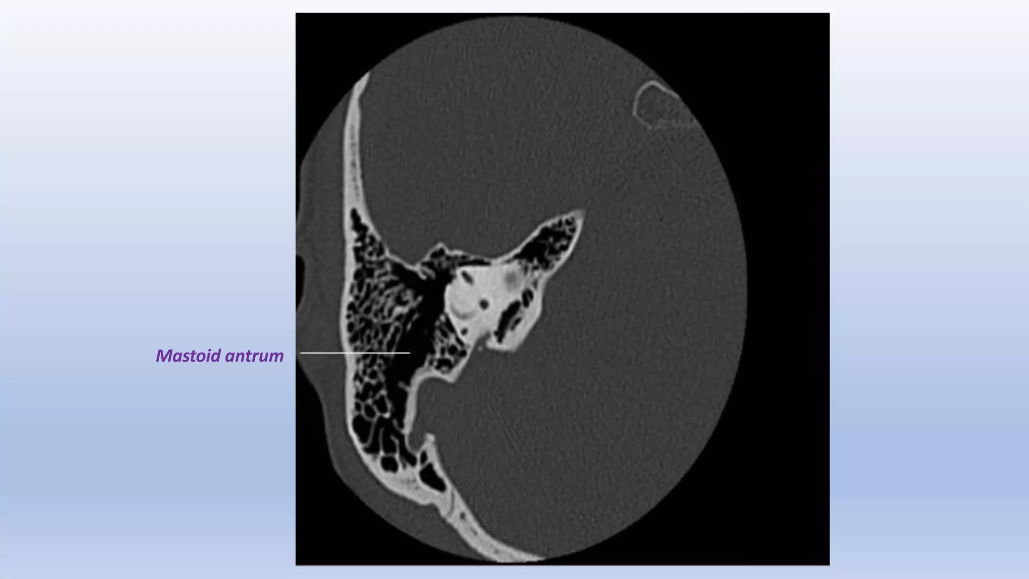 Hrct temporal bone pk1 ppt | PPTX
