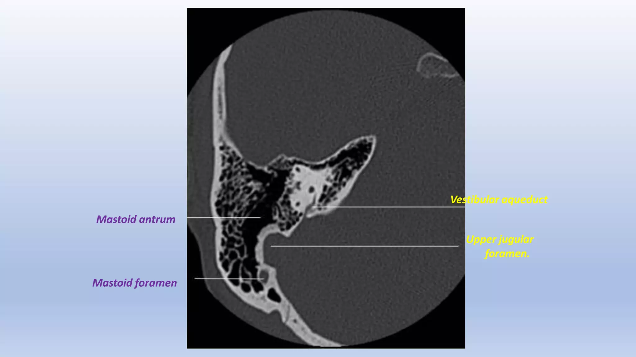Hrct temporal bone pk1 ppt | PPTX