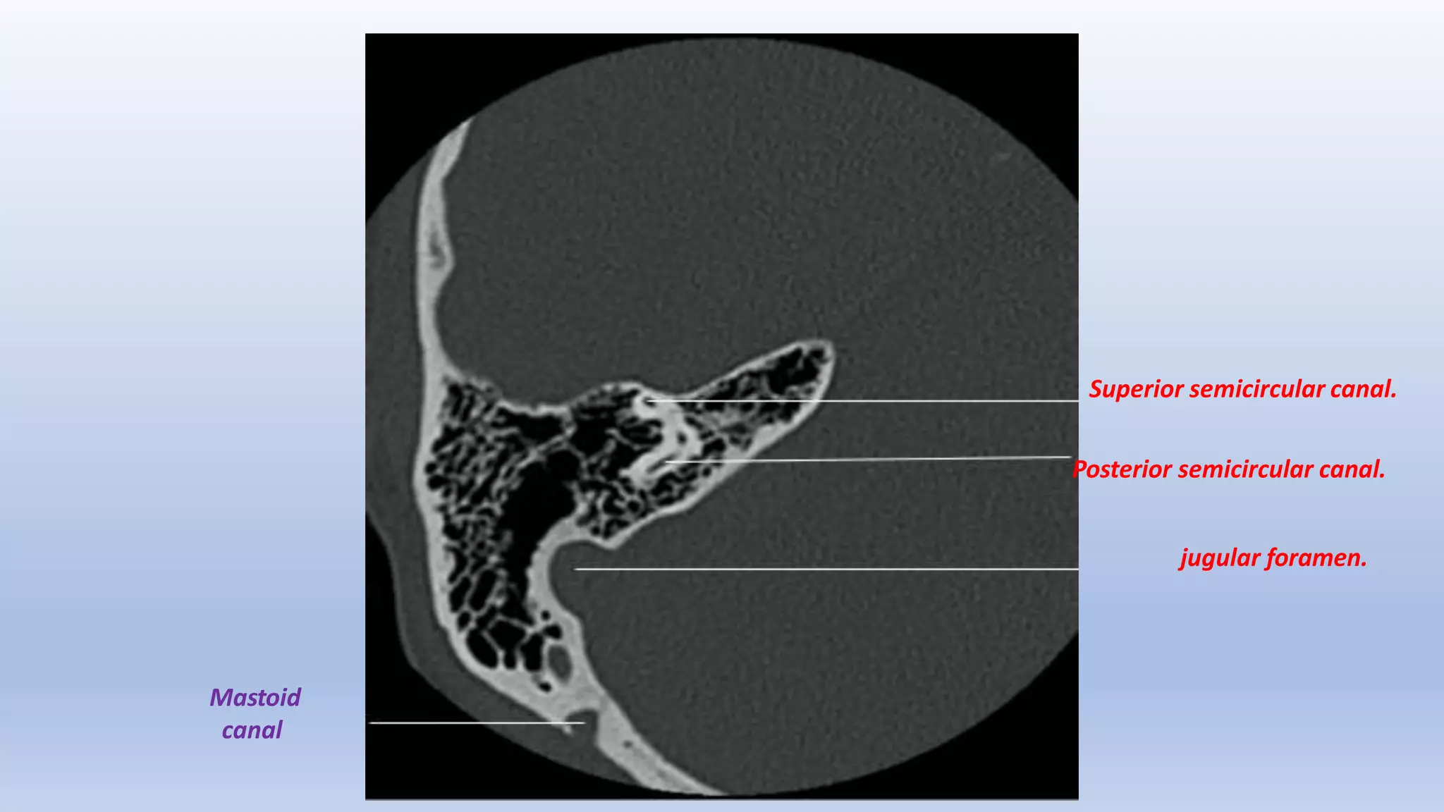 Hrct temporal bone pk1 ppt | PPTX