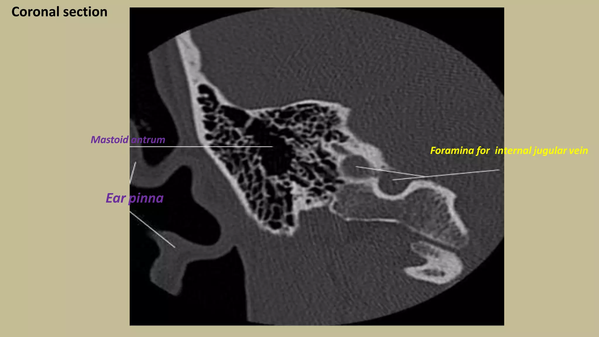 Hrct temporal bone pk1 ppt | PPTX