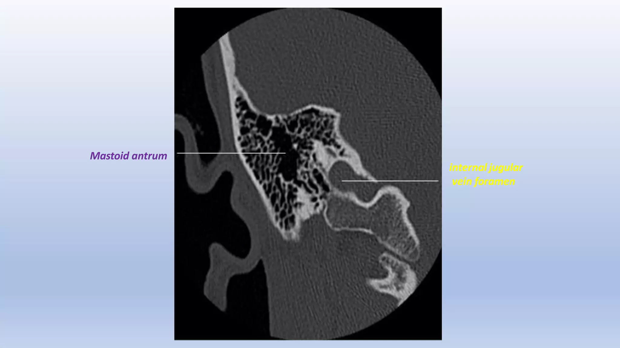 Hrct temporal bone pk1 ppt | PPTX
