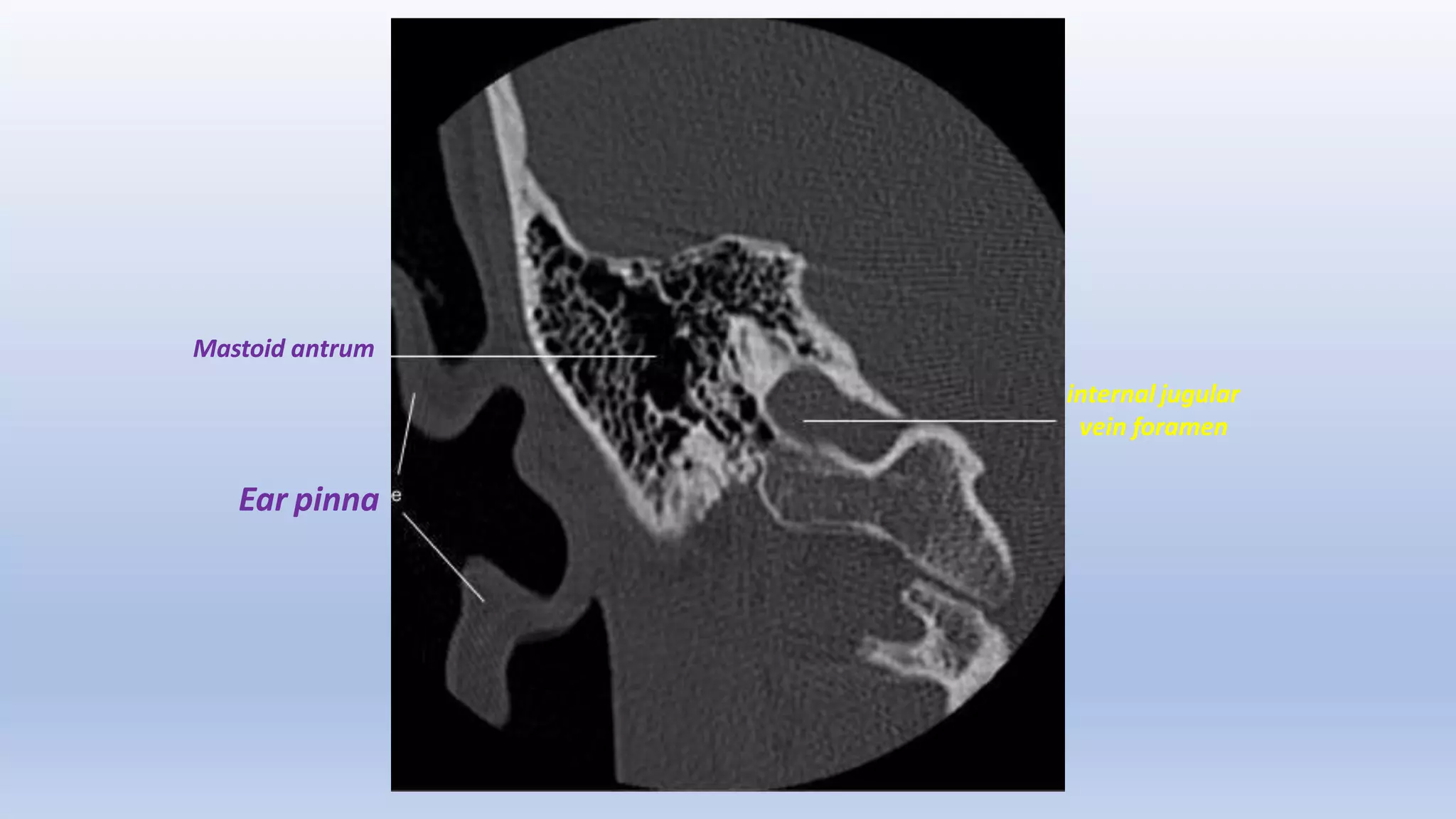 Hrct temporal bone pk1 ppt | PPTX