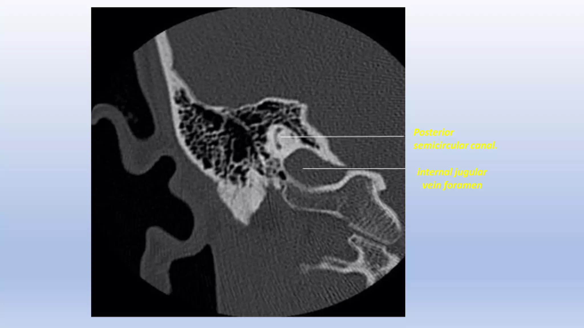 Hrct temporal bone pk1 ppt | PPTX