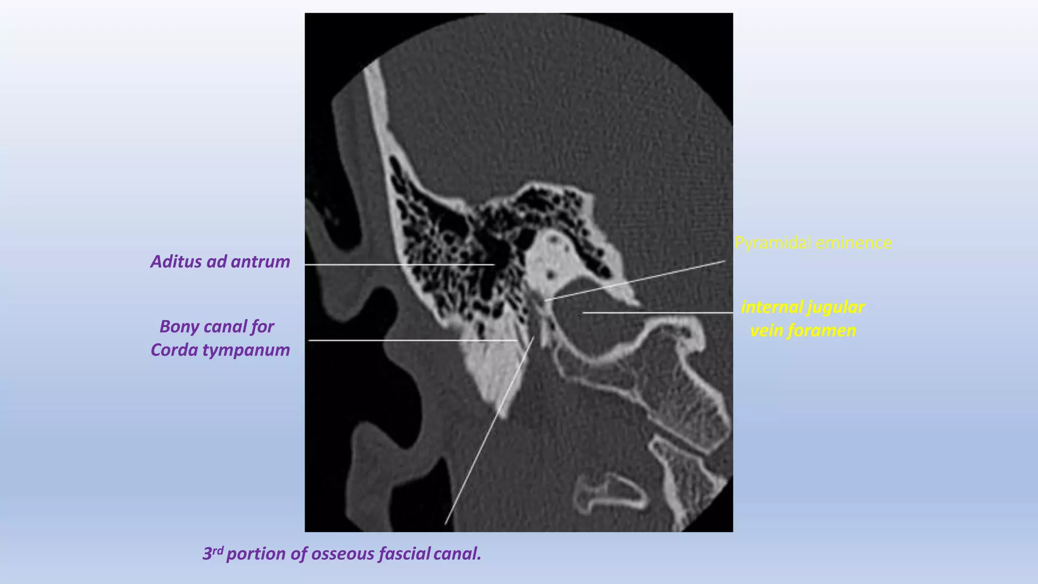 Hrct temporal bone pk1 ppt | PPTX