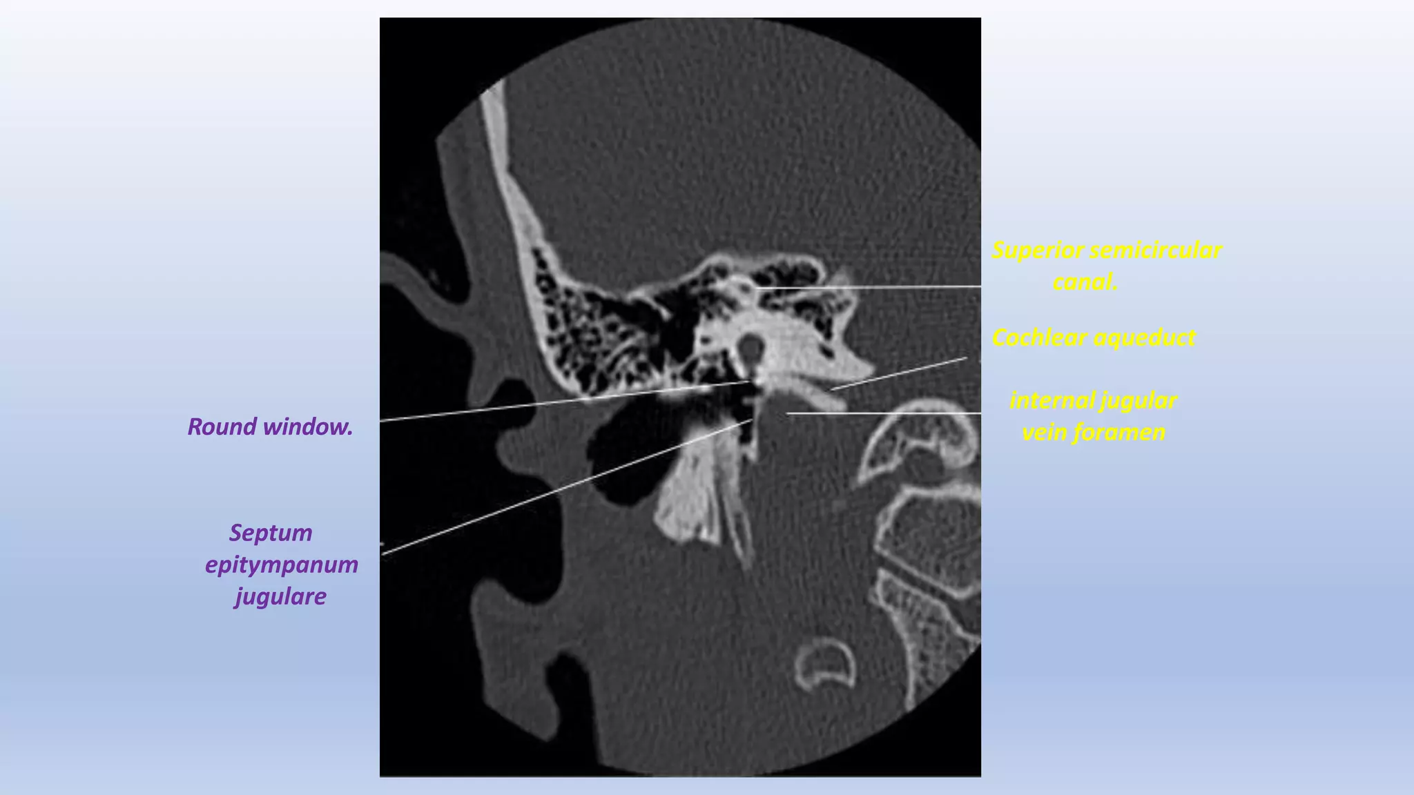 Hrct temporal bone pk1 ppt | PPTX