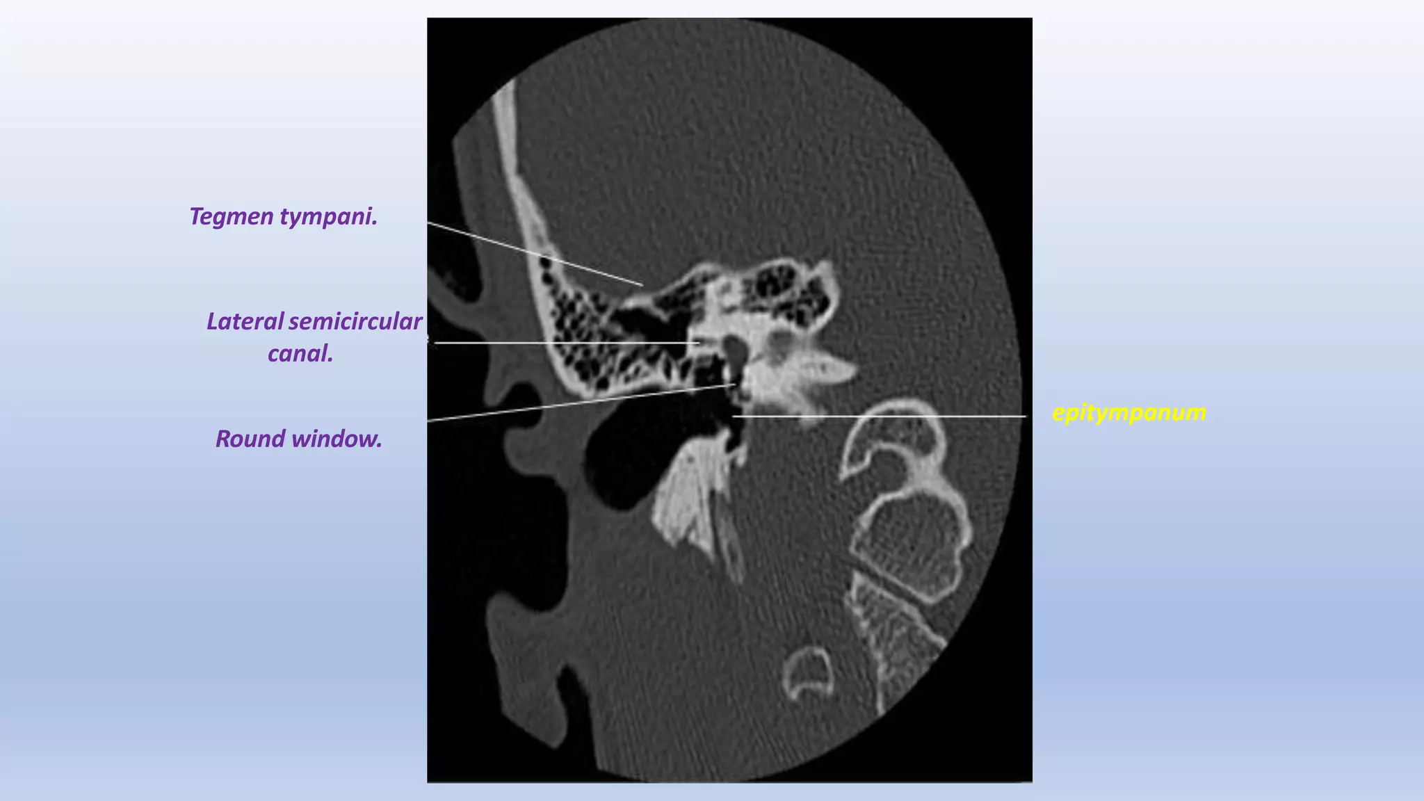 Hrct temporal bone pk1 ppt | PPTX