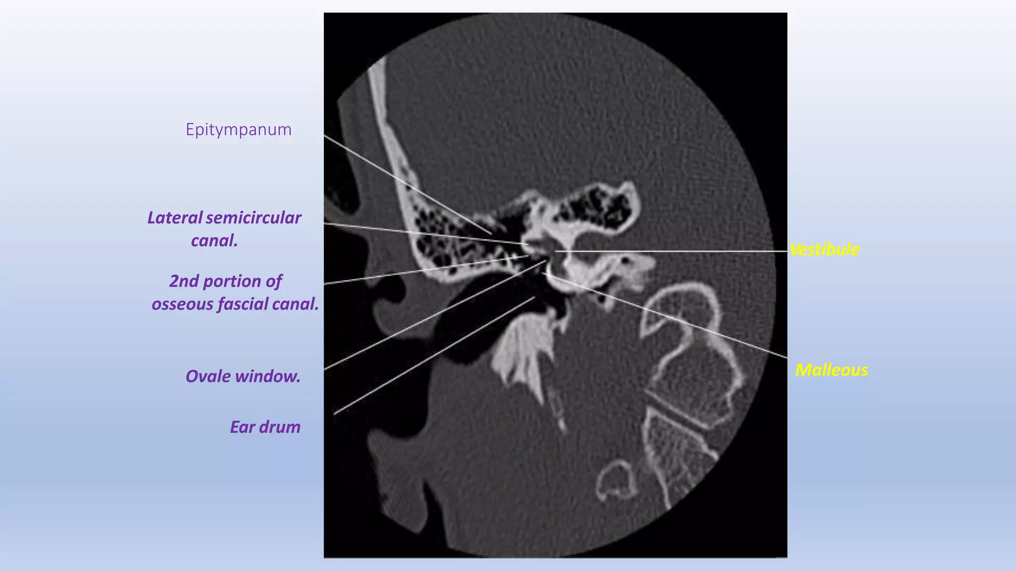 Hrct temporal bone pk1 ppt | PPTX
