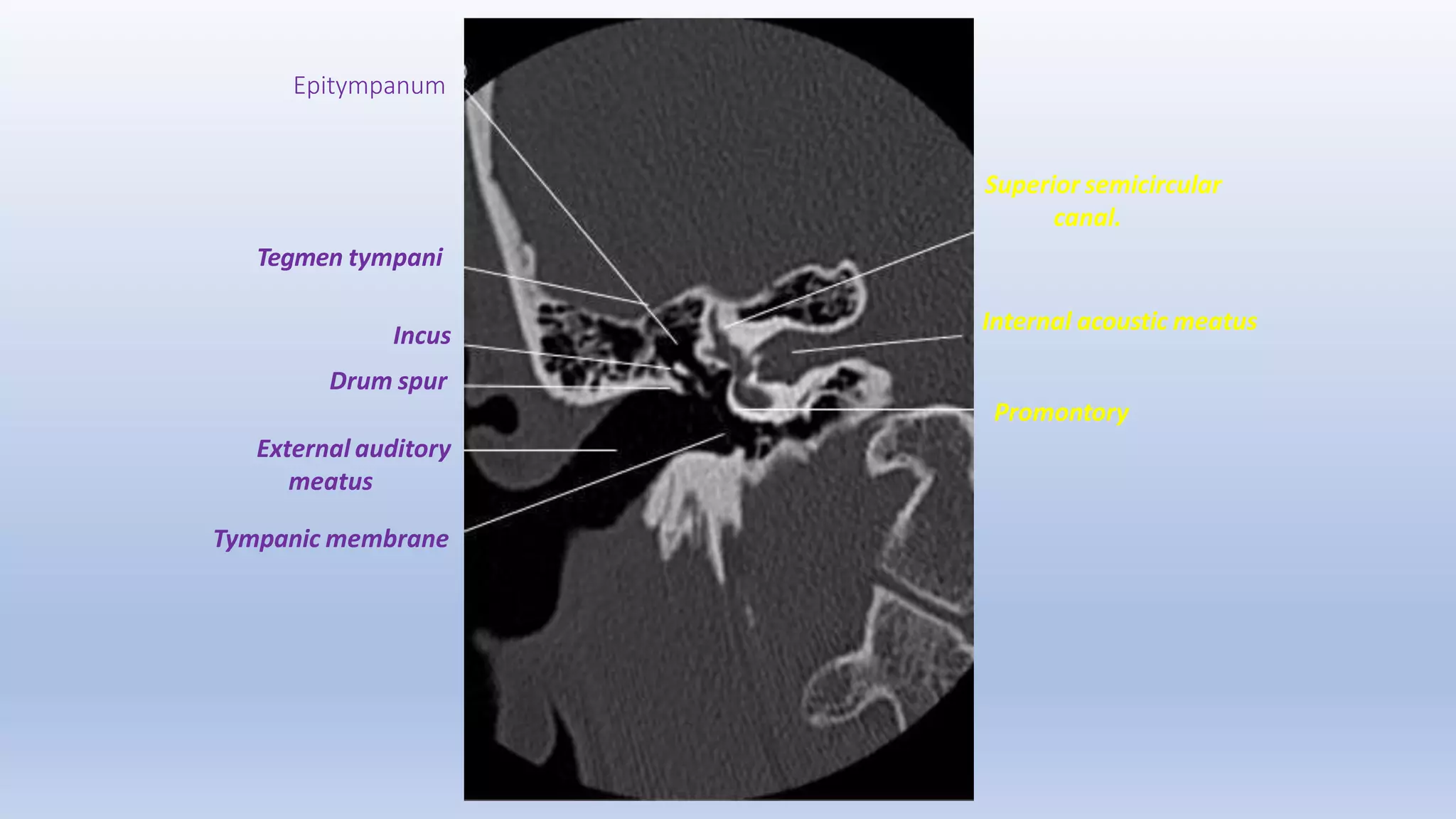 Hrct temporal bone pk1 ppt | PPTX