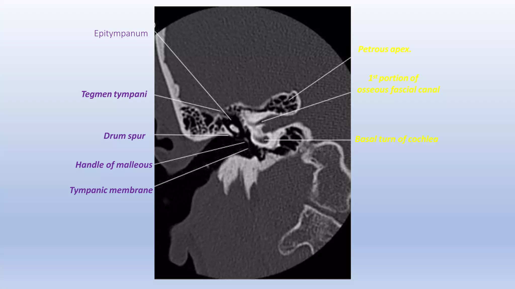 Hrct temporal bone pk1 ppt | PPTX