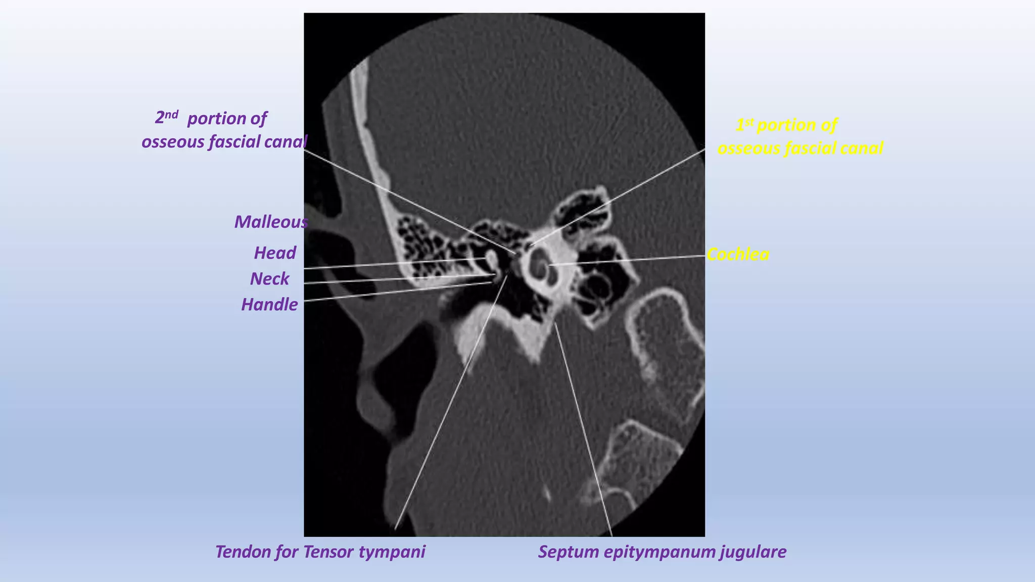 Hrct temporal bone pk1 ppt | PPTX