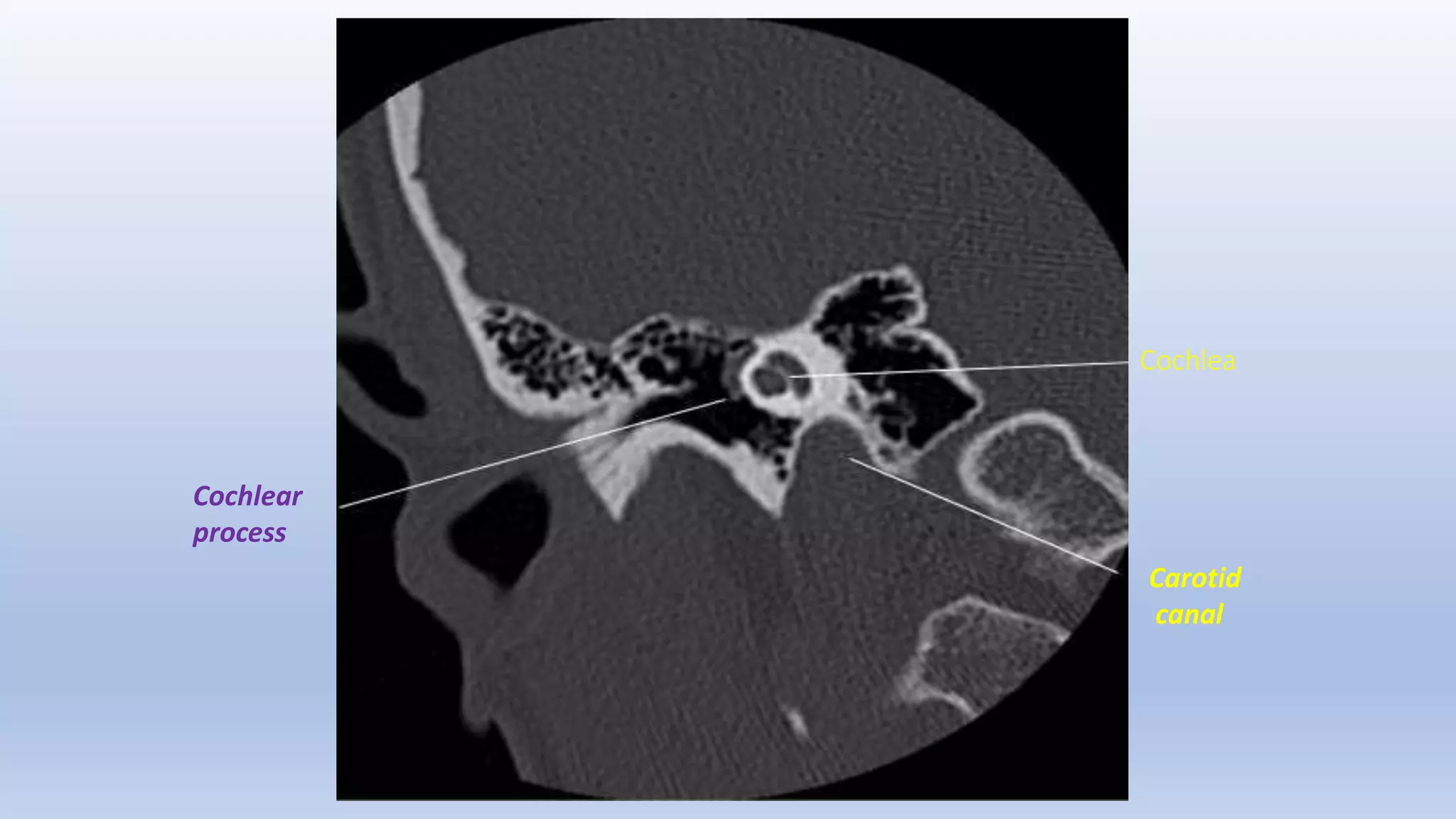 Hrct temporal bone pk1 ppt | PPTX