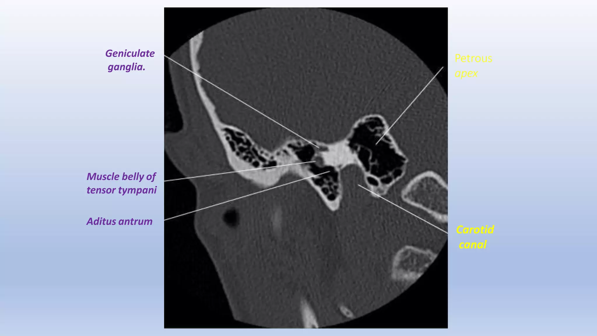 Hrct temporal bone pk1 ppt | PPTX