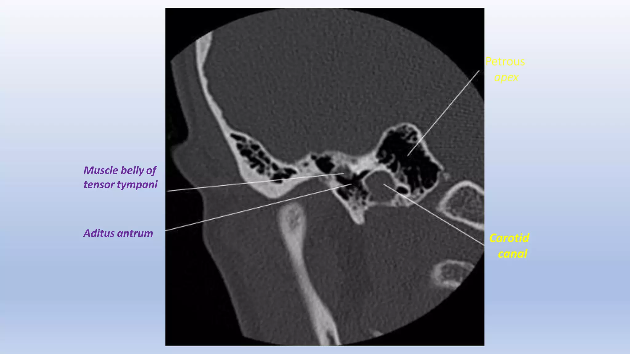 Hrct temporal bone pk1 ppt | PPTX