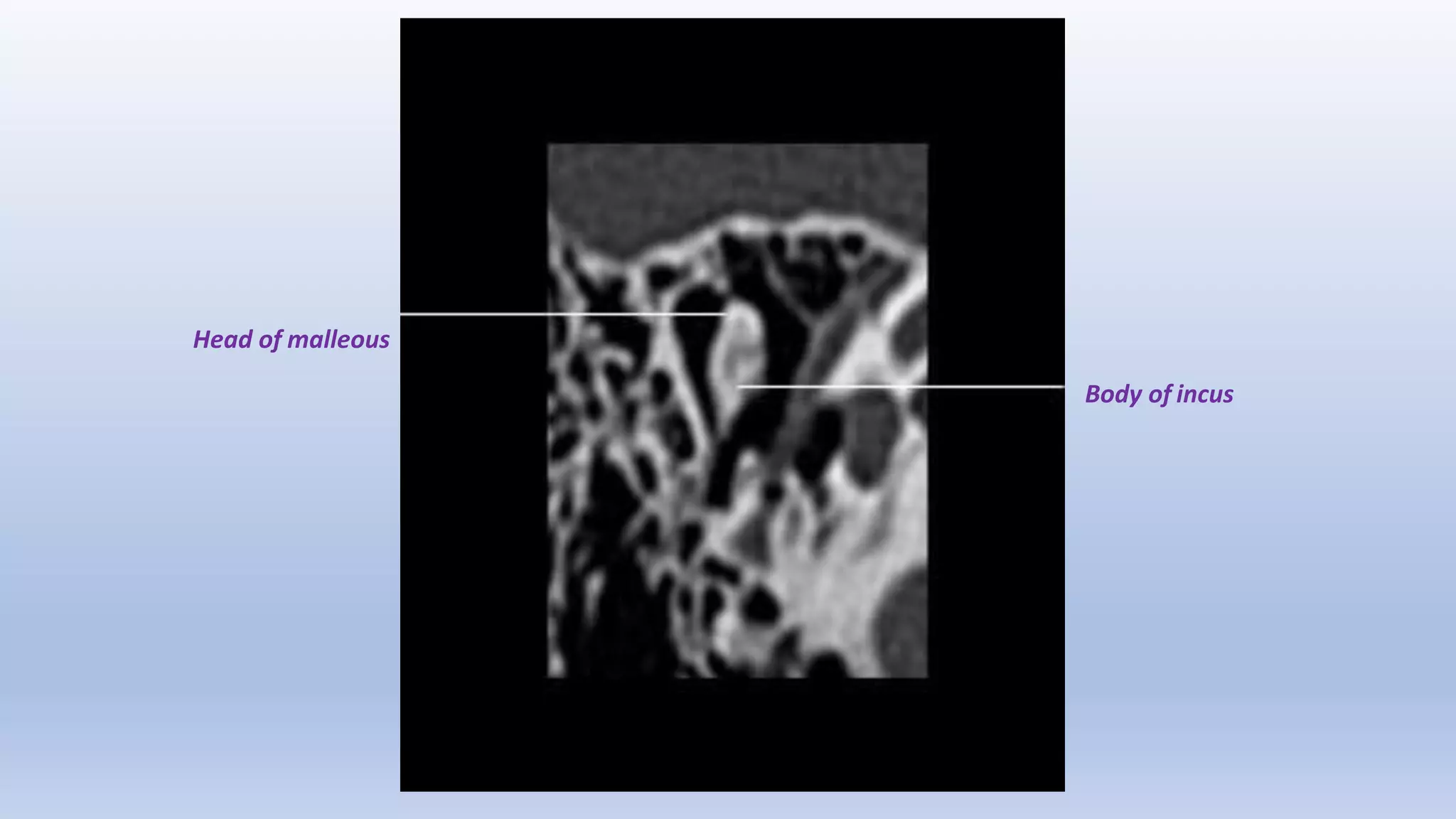 Hrct temporal bone pk1 ppt | PPTX