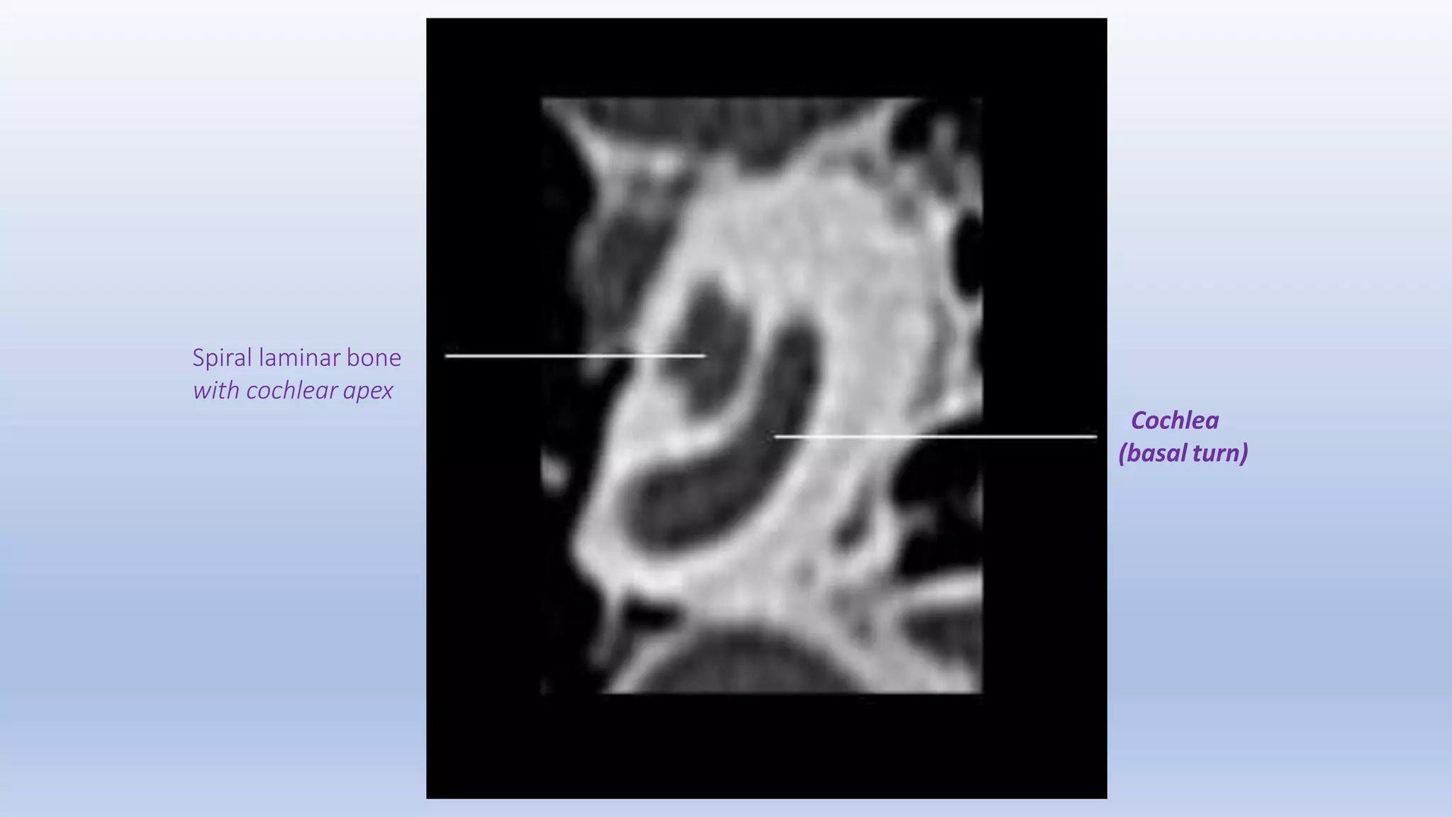 Hrct temporal bone pk1 ppt | PPTX