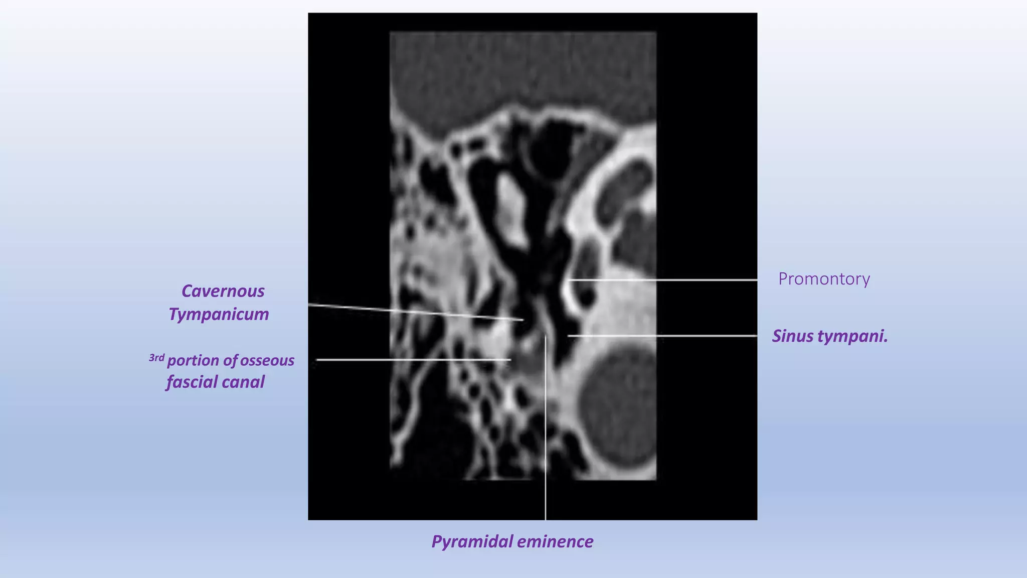 Hrct temporal bone pk1 ppt | PPTX