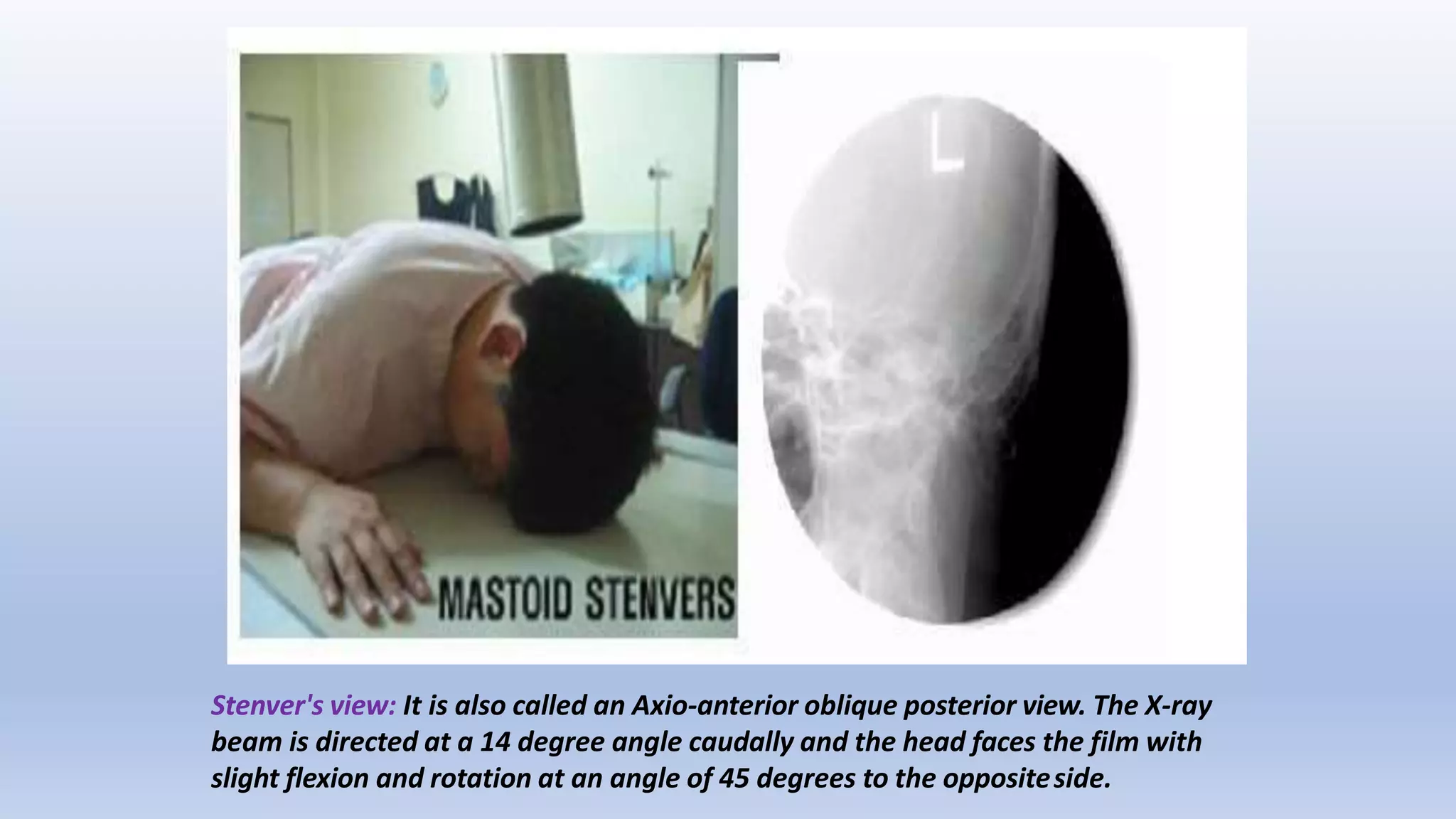 Hrct temporal bone pk1 ppt | PPTX
