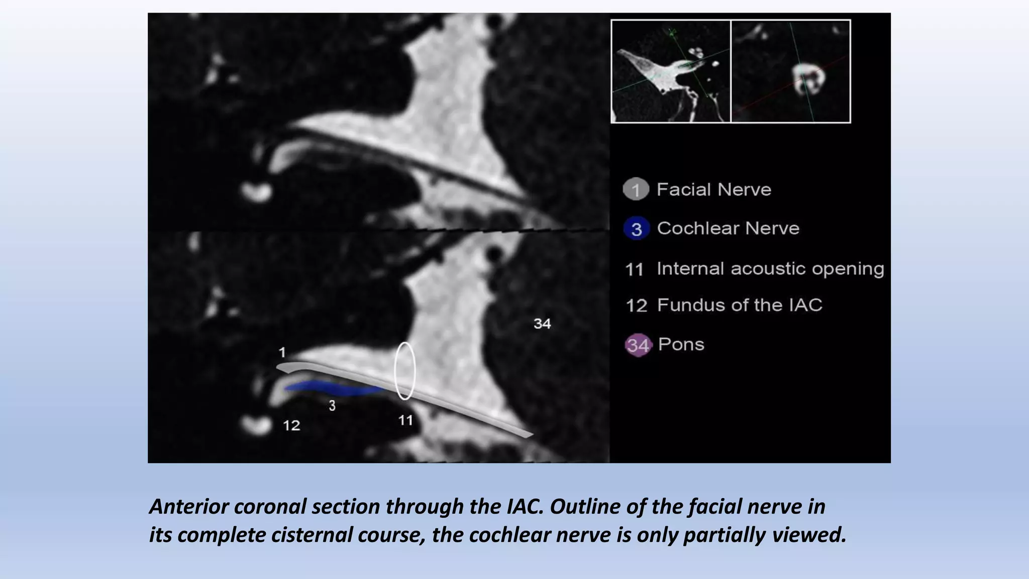 Hrct temporal bone pk1 ppt | PPTX