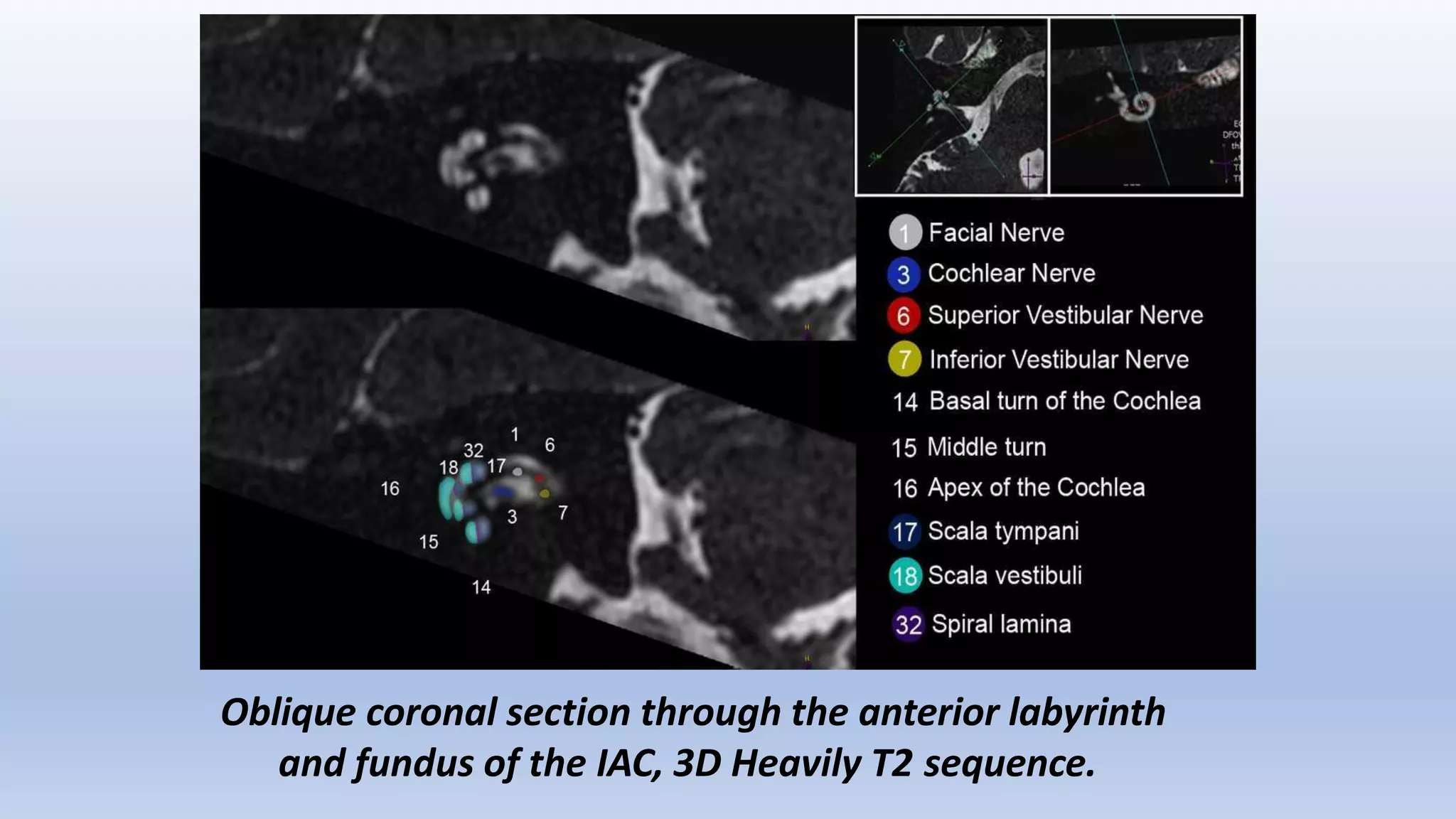 Hrct temporal bone pk1 ppt | PPTX