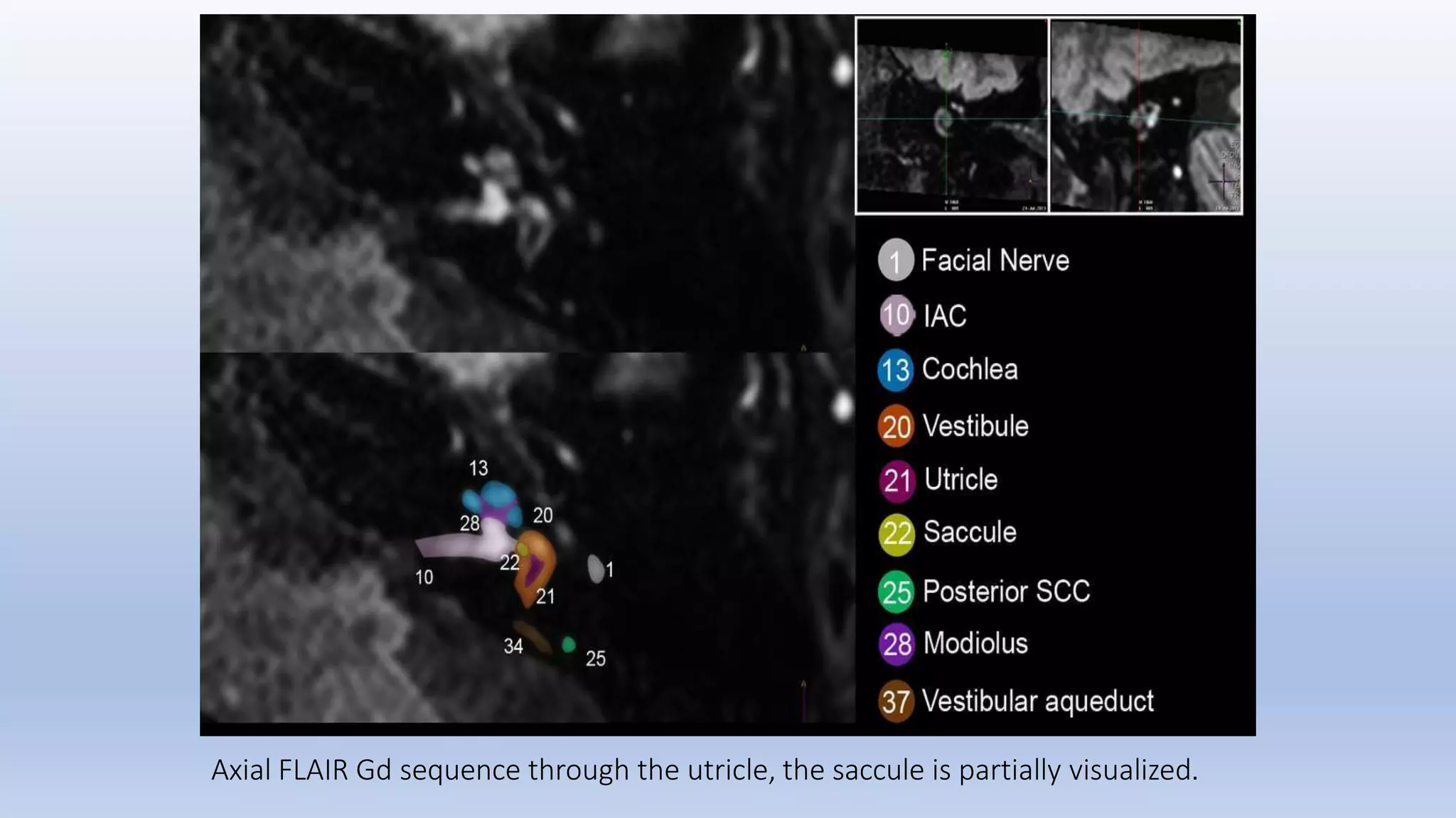 Hrct temporal bone pk1 ppt | PPTX