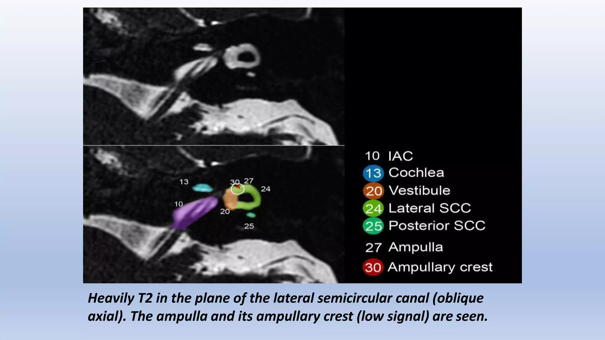 Hrct temporal bone pk1 ppt | PPTX