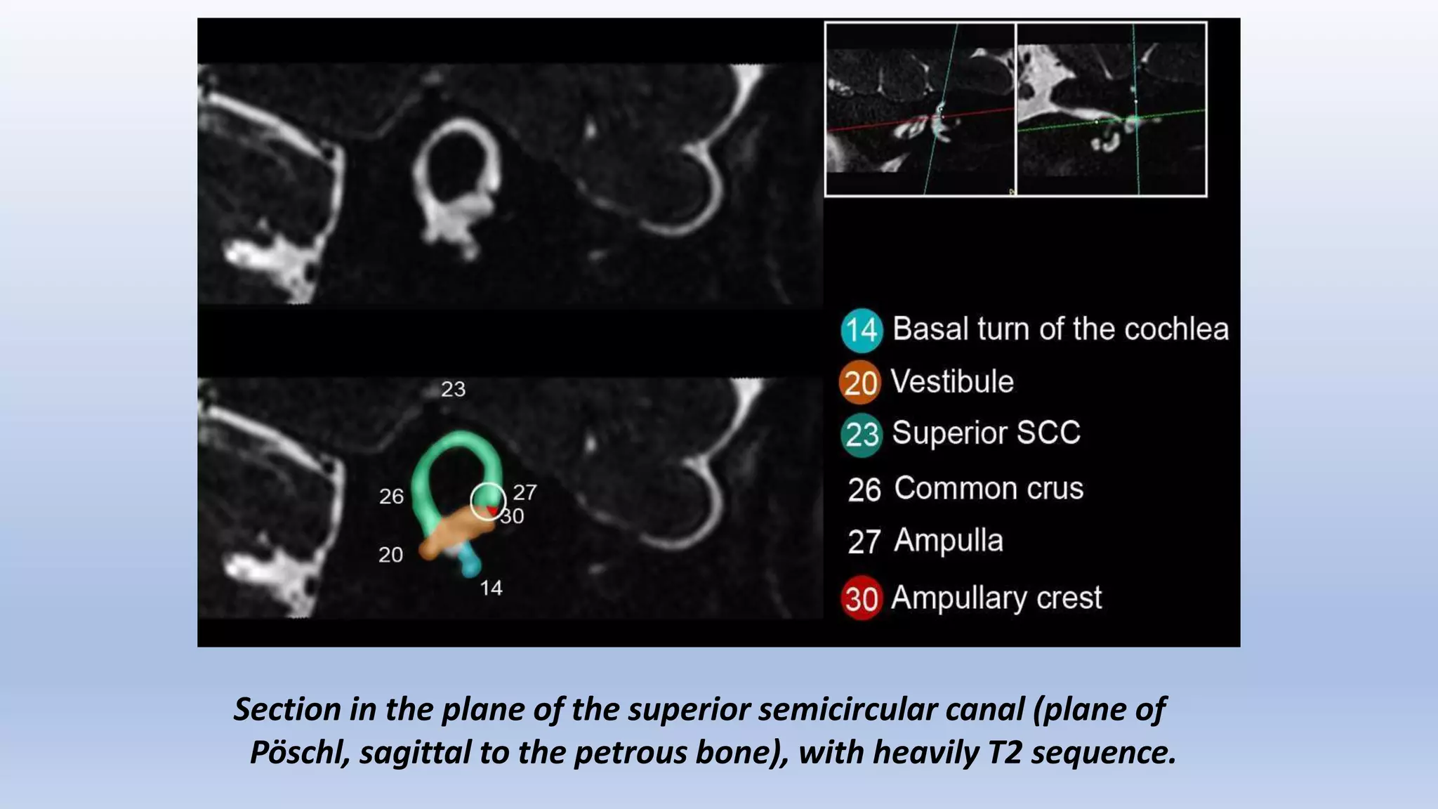 Hrct temporal bone pk1 ppt | PPTX