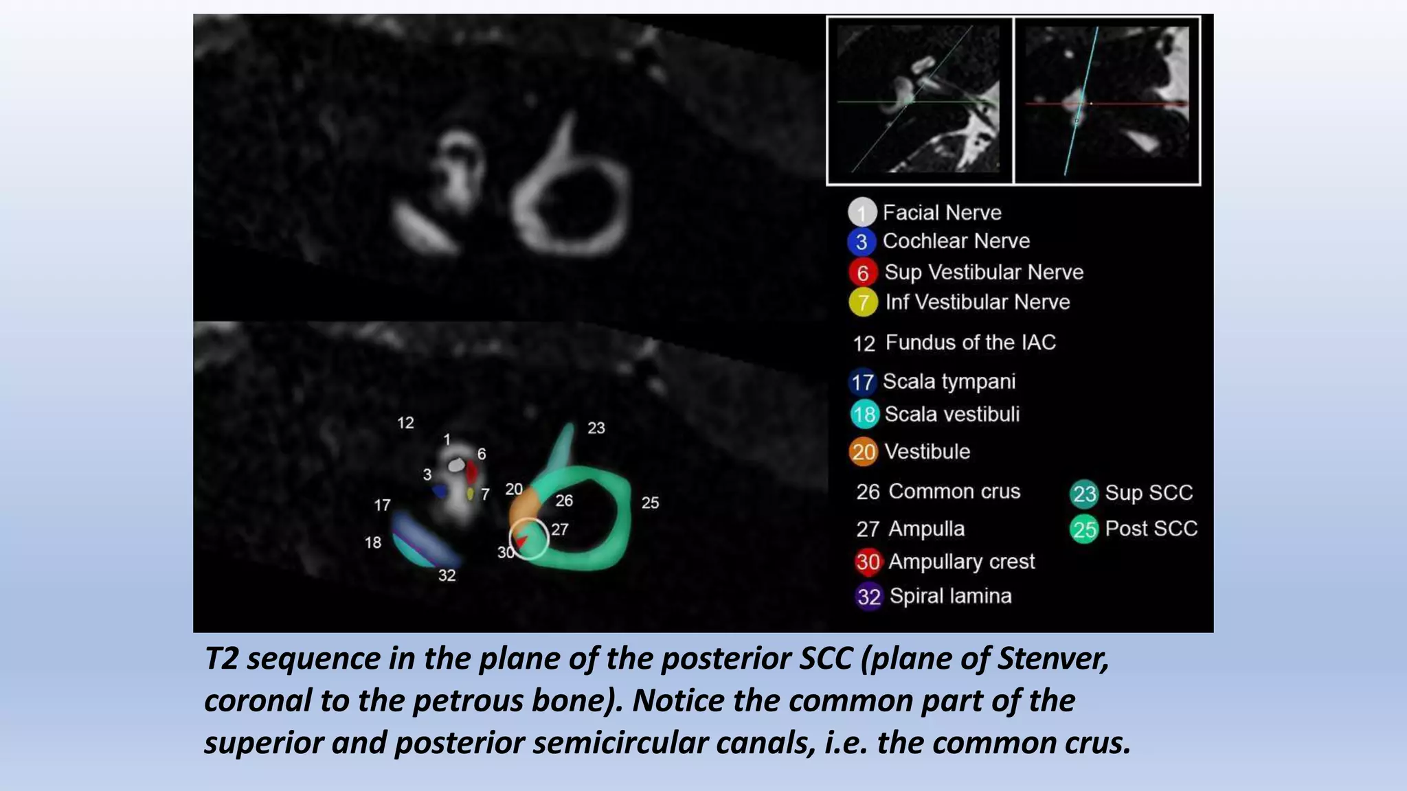Hrct temporal bone pk1 ppt | PPTX
