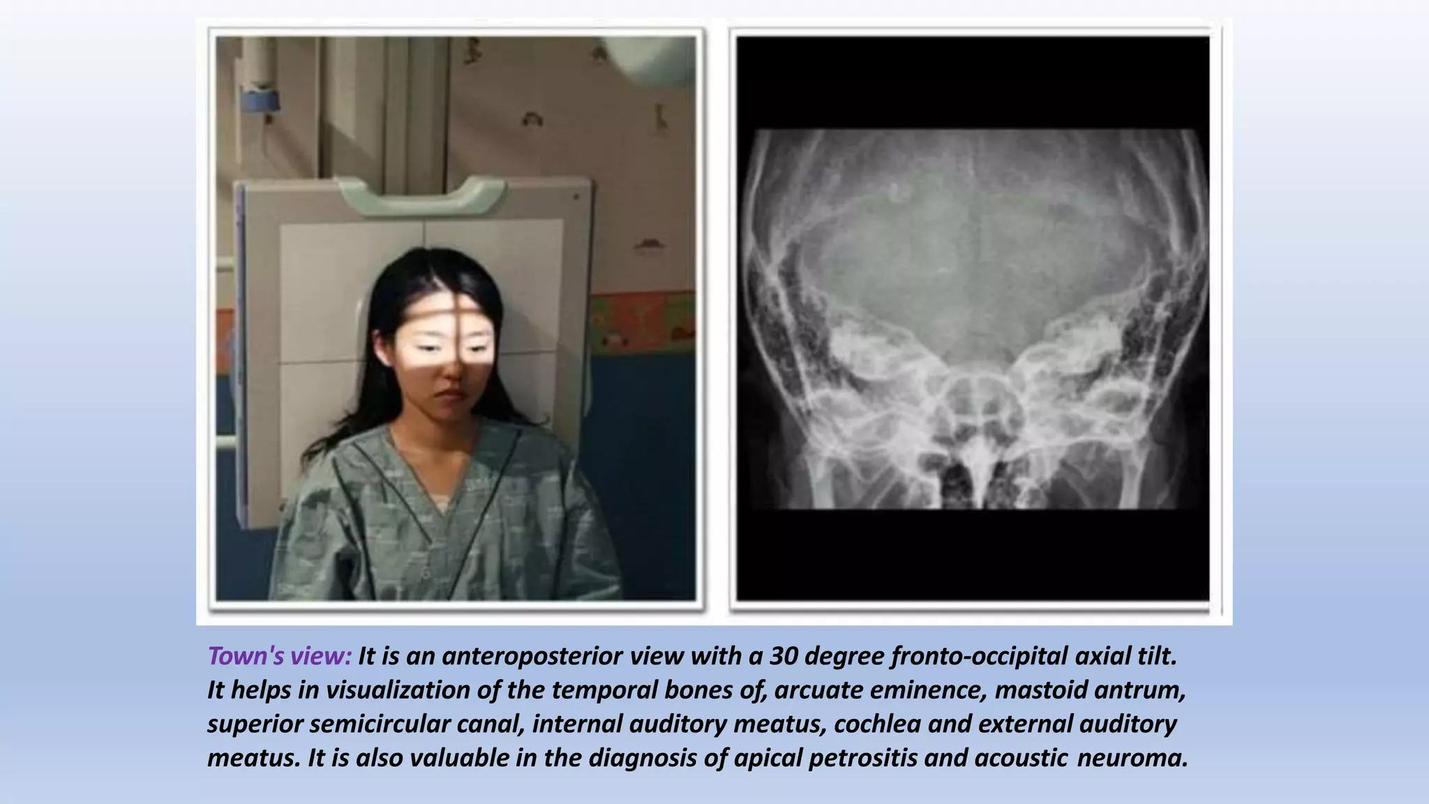 Hrct temporal bone pk1 ppt | PPTX