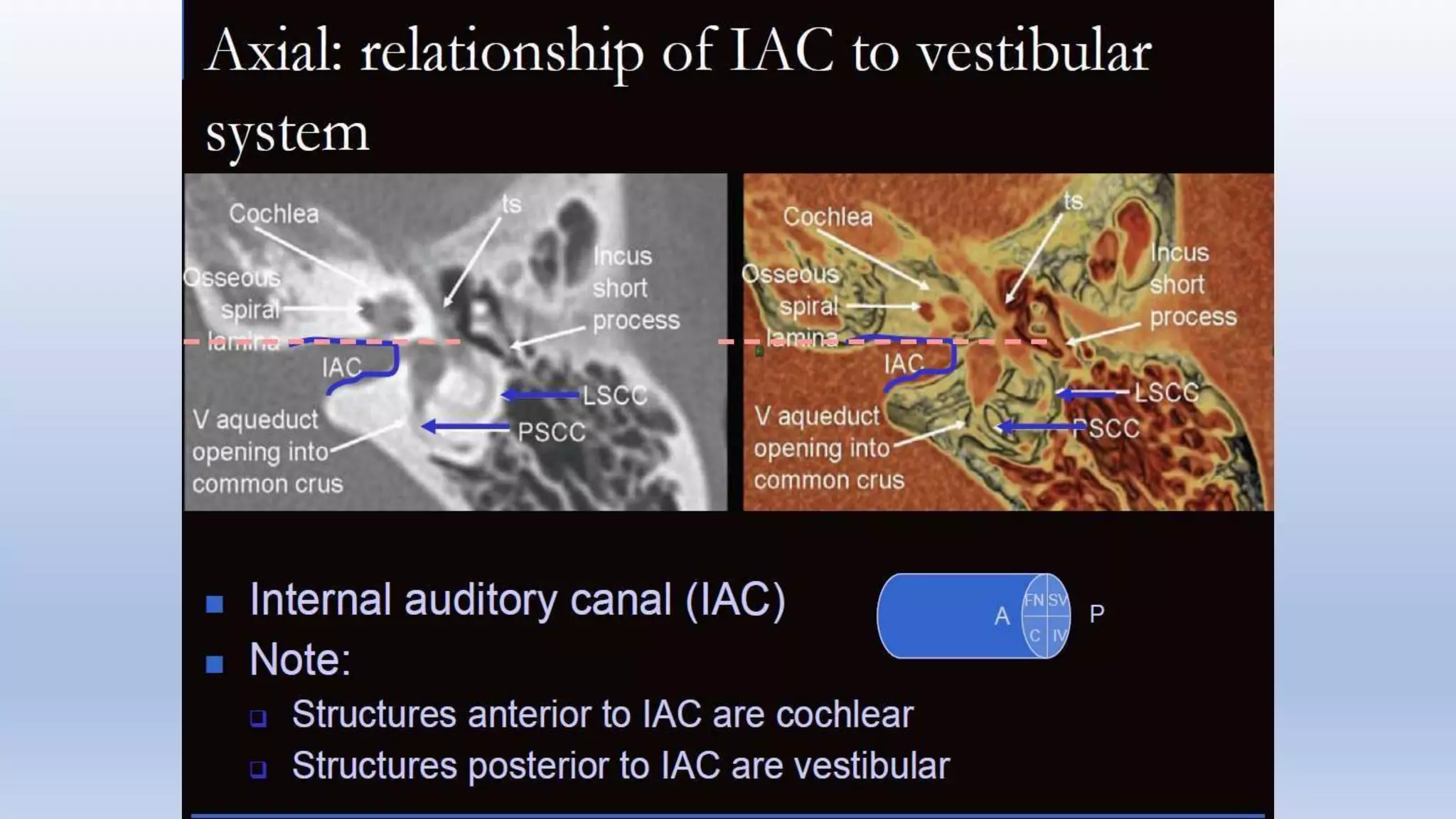 Hrct temporal bone pk1 ppt | PPTX