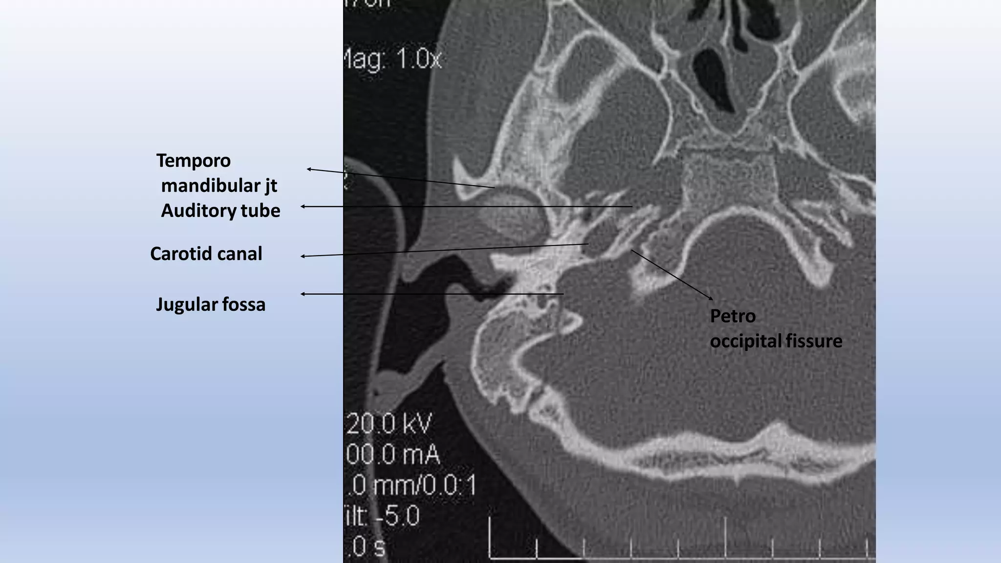 Hrct temporal bone pk1 ppt | PPTX