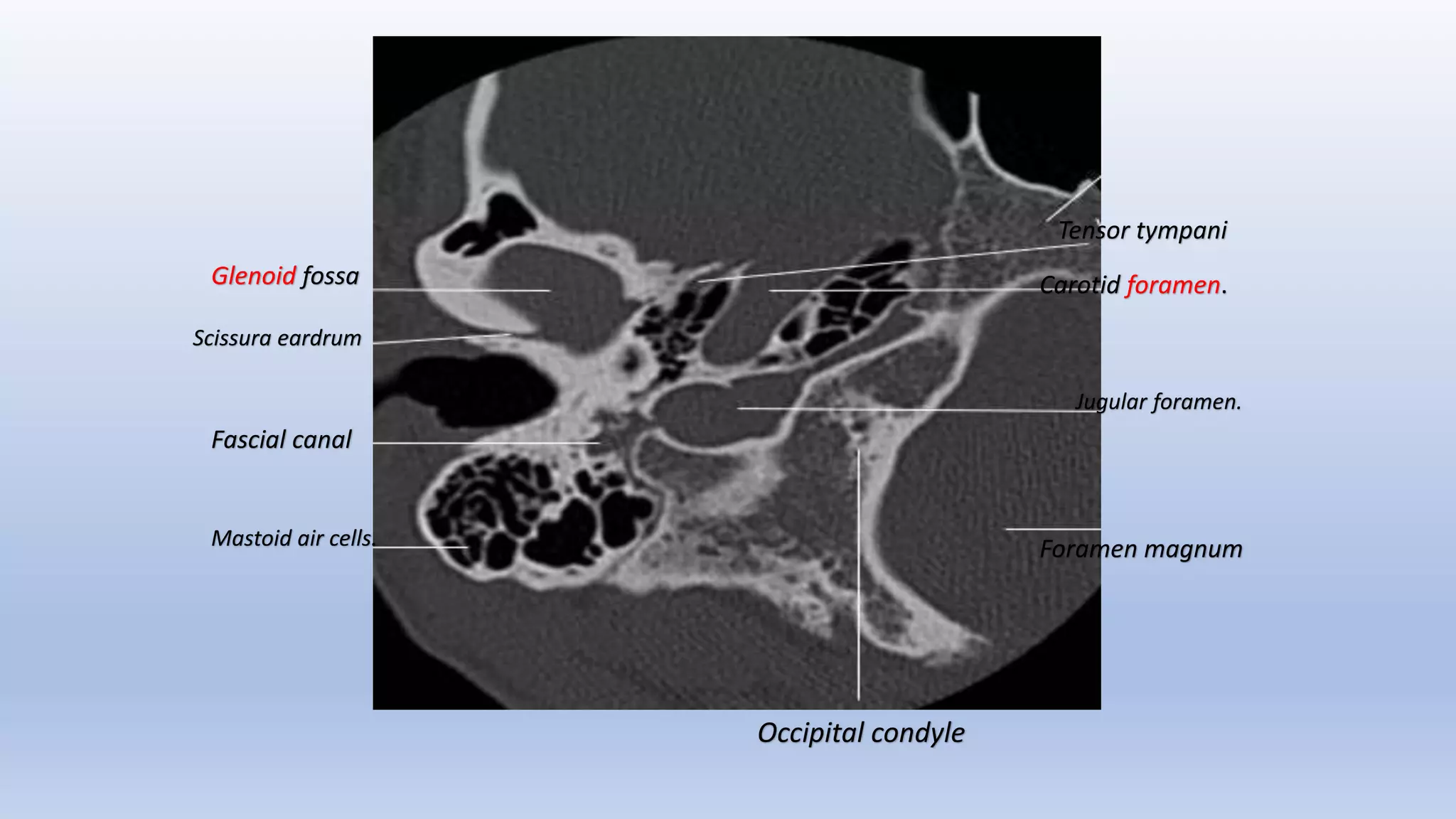 Hrct temporal bone pk1 ppt | PPTX