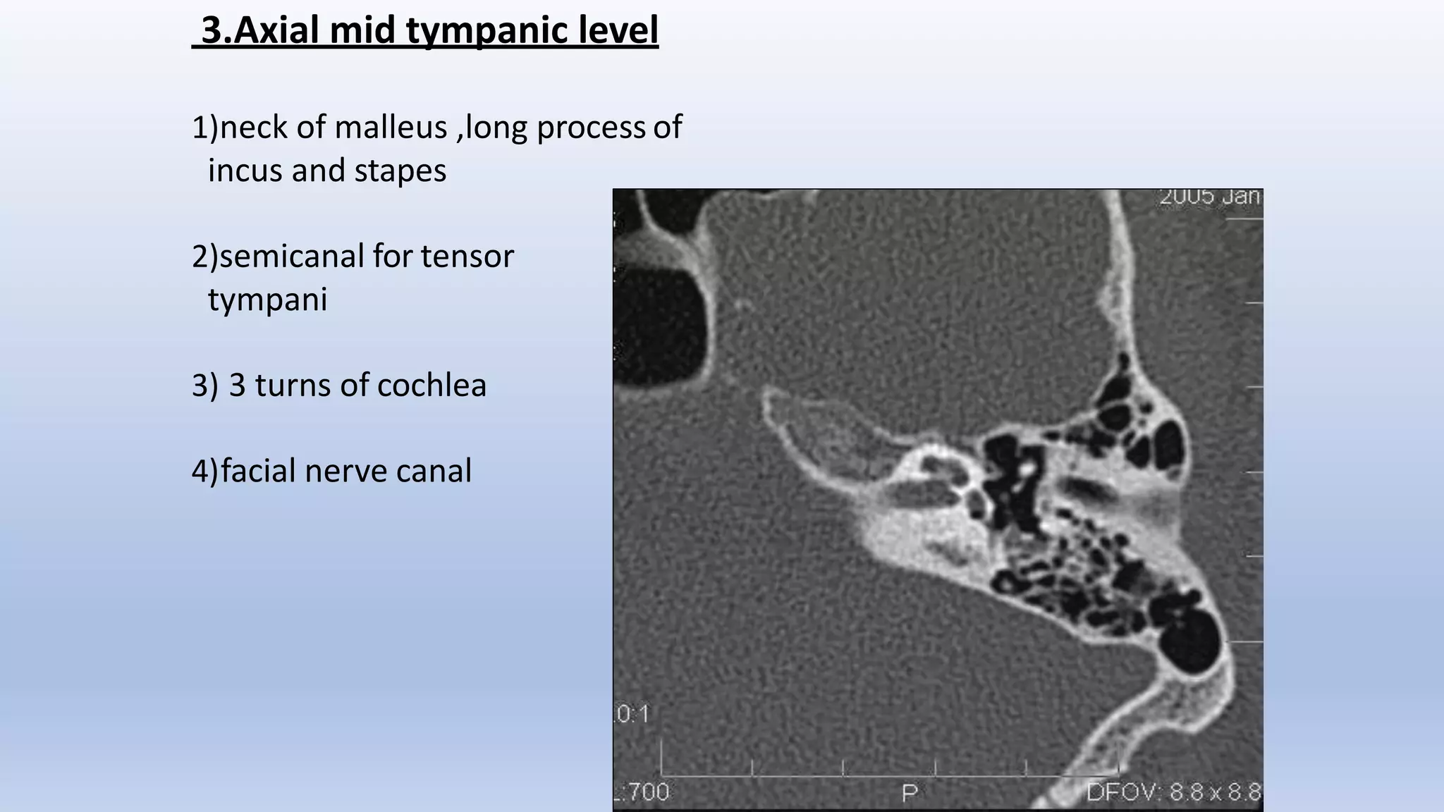 Hrct temporal bone pk1 ppt | PPTX