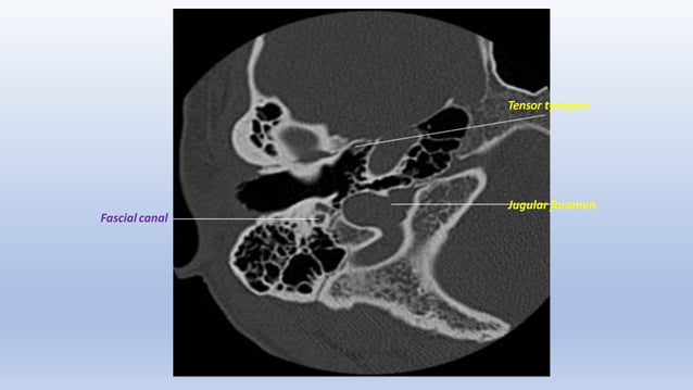 Hrct temporal bone pk1 ppt | PPTX