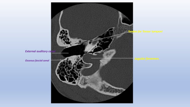 Hrct temporal bone pk1 ppt | PPTX