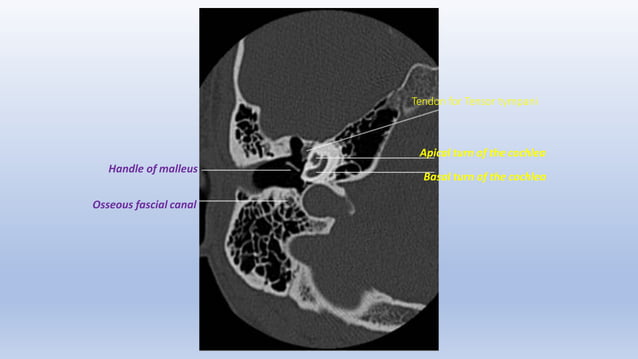 Hrct temporal bone pk1 ppt | PPTX