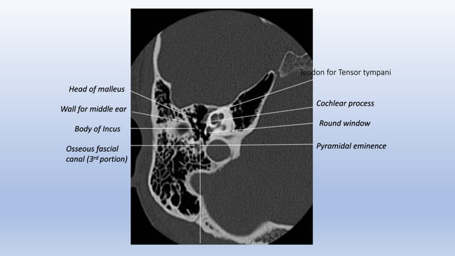 Hrct temporal bone pk1 ppt | PPTX