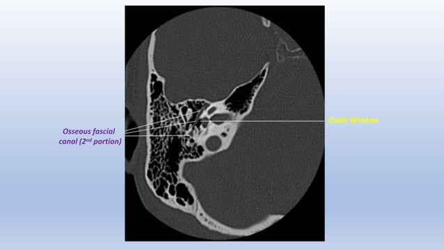 Hrct temporal bone pk1 ppt | PPTX