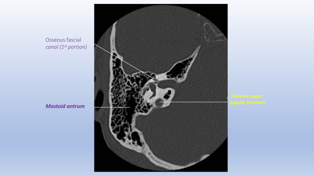 Hrct temporal bone pk1 ppt | PPTX