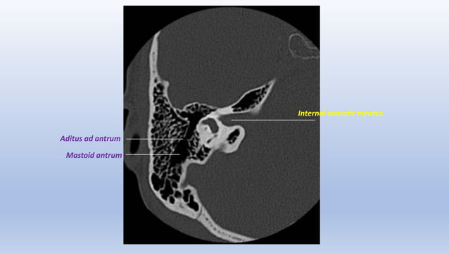 Hrct temporal bone pk1 ppt | PPTX